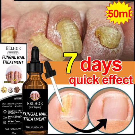 Eelhoe Nail Fungus Treatment Serum 50ml Anti Fungal Nail Fungal