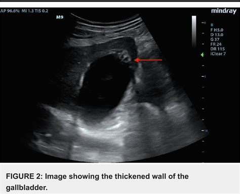 Emphysematous Cholecystitis Ultrasound
