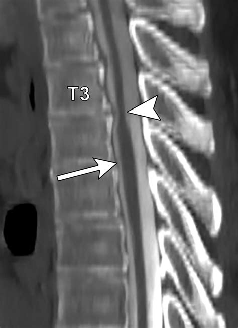 Diagnostic Approach To Intrinsic Abnormality Of Spinal Cord Signal