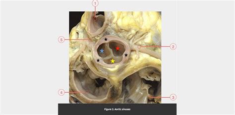 Straight Sinus Cadaver