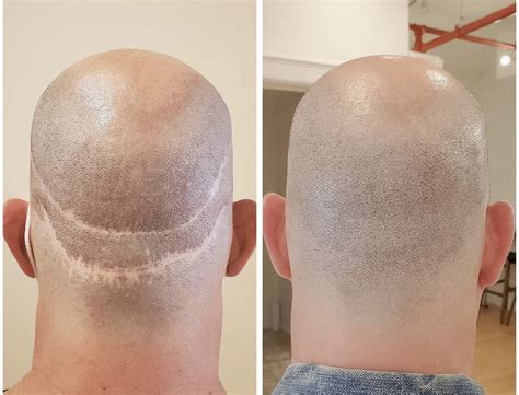 The Truth About Hair Transplants In Istanbul Scalp Micro Usa