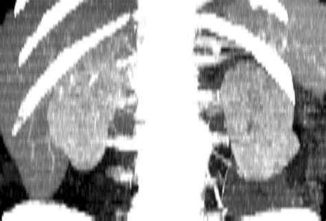 Artifacts In Ct Recognition And Avoidance Radiographics