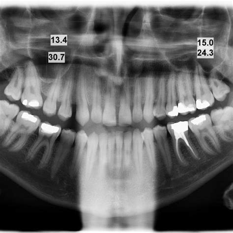 Right Maxillary Sinus Pneumatization After 11 Years Of Right First