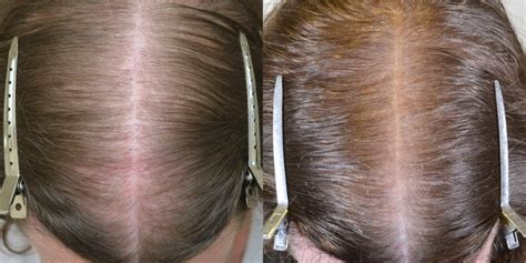 Spironolactone For Females Only Before And After Photos Hair