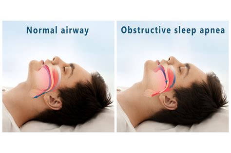 Bellevue Ent Snoring And Sleep Apnea