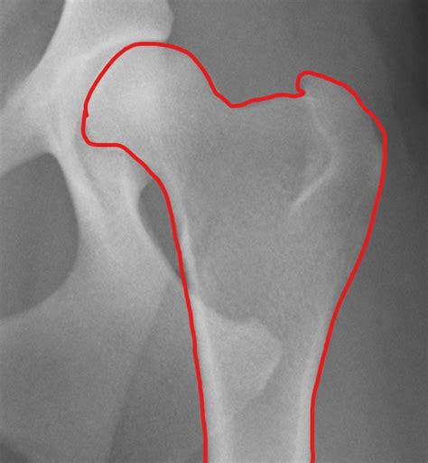 python how to segment femur from x ray in opencv
