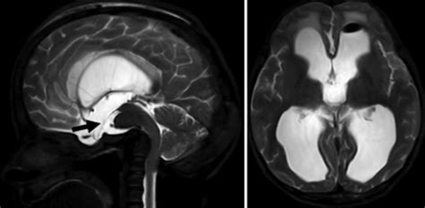 Obstructive Hydrocephalus Treated With Endoscopic Third Ventriculostomy