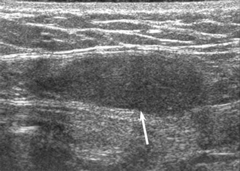 Sonographic Findings Of Groin Masses Yang 2007 Journal Of