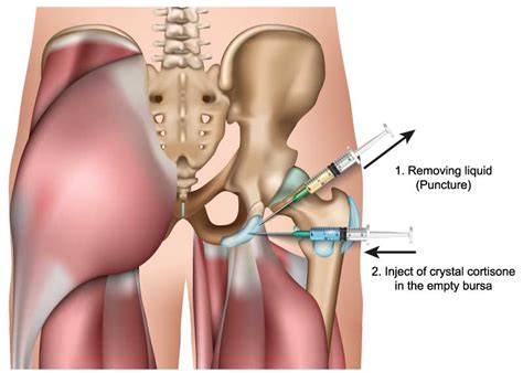bursal sac injections altair health