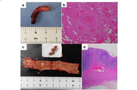 Macroscopic And Pathological Findings Of The Resected Specimens A