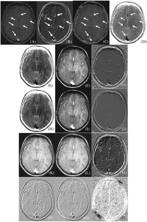 Mri Of One Subject Is Presented In A The Picture Also Presents