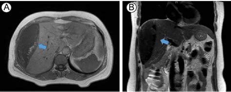 Magnetic Resonance Imaging Finding At Initial Presentation About 13 Cm