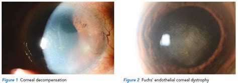 Endothelial Keratoplasty And Emerging Therapies For Corneal Endothelial