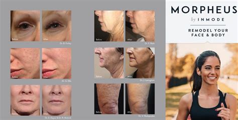 Morpheus Rf Microneedling Vs Microneedling – Cascades Med Spa