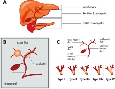 Evaluation And Management Of Intrahepatic And Extrahepatic