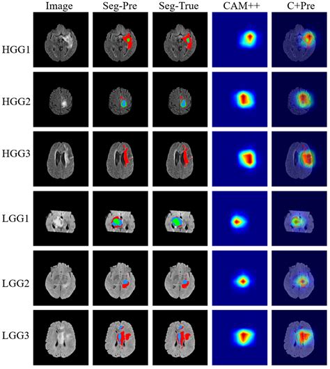 Applied Sciences Free Full Text An Explainable Brain Tumor