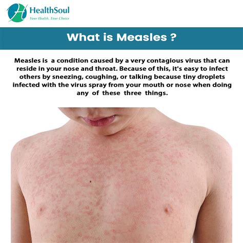 Measles Symptoms And Treatment – Healthsoul