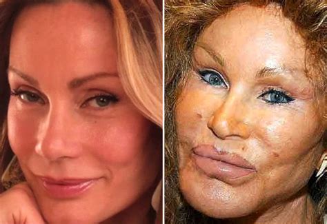 Los Antes Y Después De Las Celebridades Tras El Botox Emol Fotos