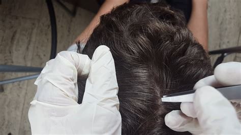 Asmr Real Person Scalp Check Up And Treatment Trigger Sounds Youtube