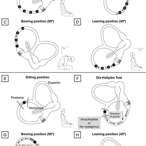 Nystagmus Direction As Evidenced At Each Lateralization Test Per