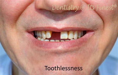 Toothlessness Causes Types Prevalence Adults How To Replace Risk