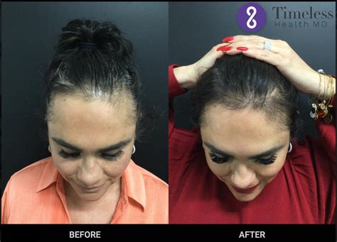 Top 141 Prp Hair Restoration Before And After Polarrunningexpeditions