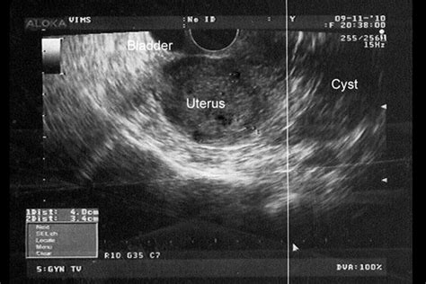 A Rare Case Of Posterior Vaginal Wall Cyst Jayaprakash Et Al 2011
