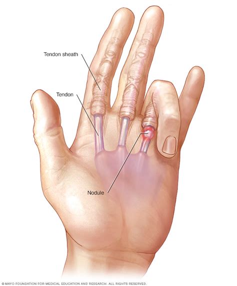 trigger finger disease reference guide