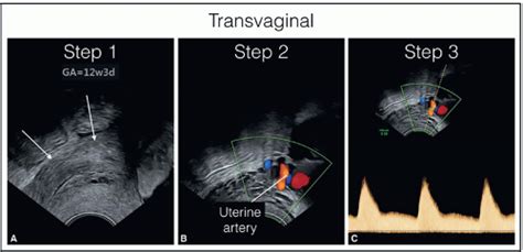 The Detailed First Trimester Ultrasound Examination Radiology Key