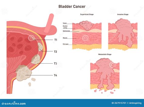 Stages Of Bladder Cancer Human Internal Organ Wall With A Developing