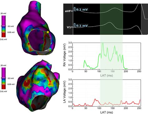 flutter wave morphology of peri mitral atrial flutters is mainly