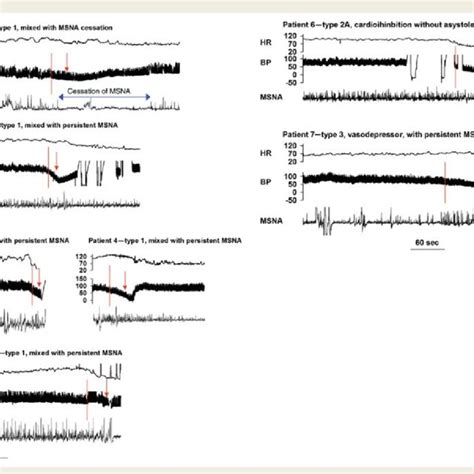 Simultaneous Recordings Of Muscle Sympathetic Nerve Activity Msna