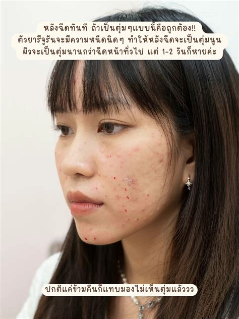 เปิดหน้าหลังฉีดรีจูรันครั้งแรก💉🇰🇷 ฉ่ำจริงมั้ย ทำไมสาวเกาหลีทุกคนฉีด⁉️😱