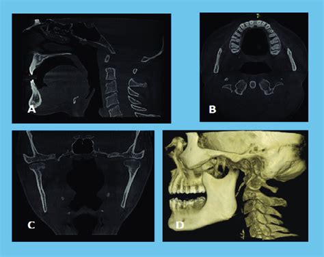 Cbct Scans Extended Fov For Orthodontic And Airway Analysis Download