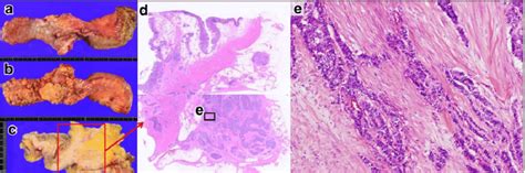 Macroscopic And Microscopic Findings Of The Resected Specimen A