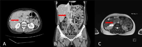 A And B Computed Tomography Angiography Of The Abdomen And Pelvis
