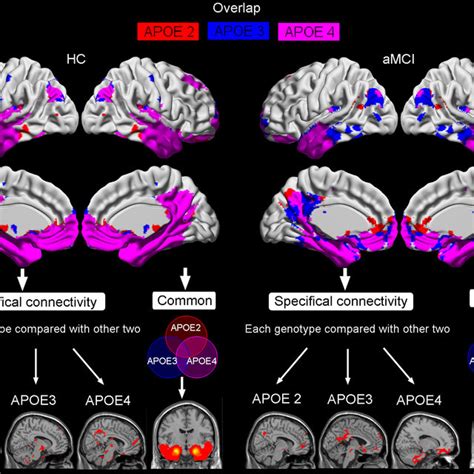 The Overlap Of Resting State Intrinsic Connectivity Network Maps In Hc
