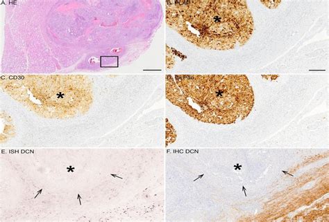 Representative Tissue Sample Of A Malignant Testicular Embryonal