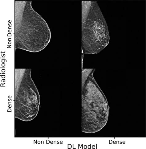 Mammographic Breast Density Assessment Using Deep Learning Clinical