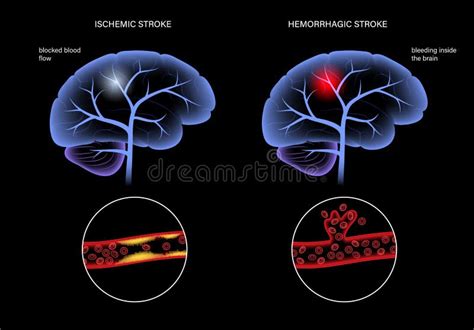 Ischemic Vs Hemorrhagic Head Stroke Anatomical Comparison Outline