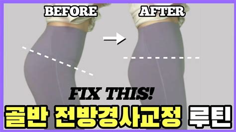 골반 전방경사 교정루틴‼️오리엉덩이 복부비만 허리통증 오다리 엑스자다리 일자다리 납작배 만들기⭕️ Youtube