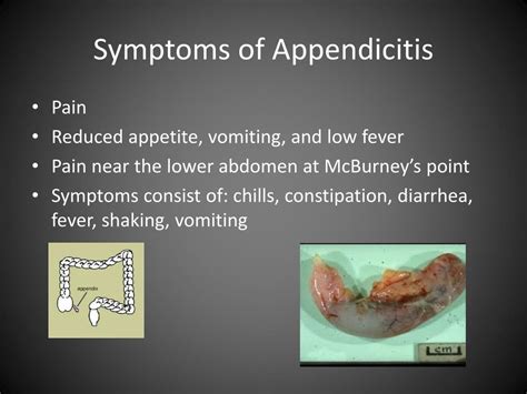 Ppt Appendicitis Powerpoint Presentation Free Download Id 4175359