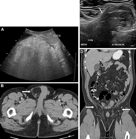 Gamut Of Extratesticular Scrotal Masses Anatomic Approach To