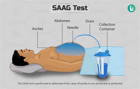 Saag Serum Ascites Albumin Gradient Kantipur Path Lab