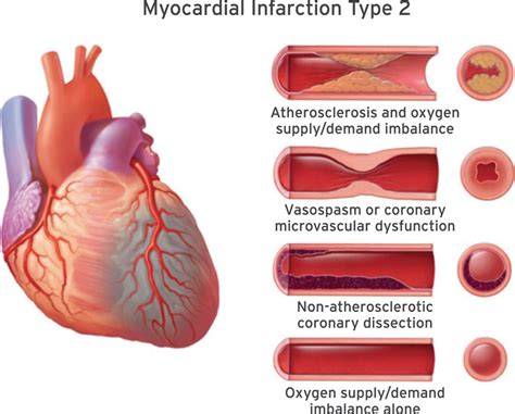 Myocardial Infarction Classification
