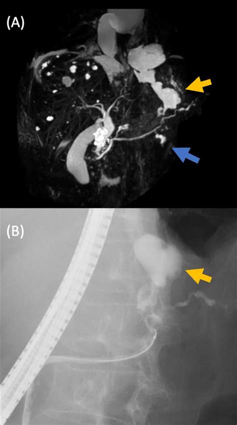 A Mrcp Shows Cystic Masses Blue Arrow And Pancreatic Tail Cysts