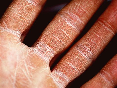 What Is Occupational Dermatitis Occupational Medicine
