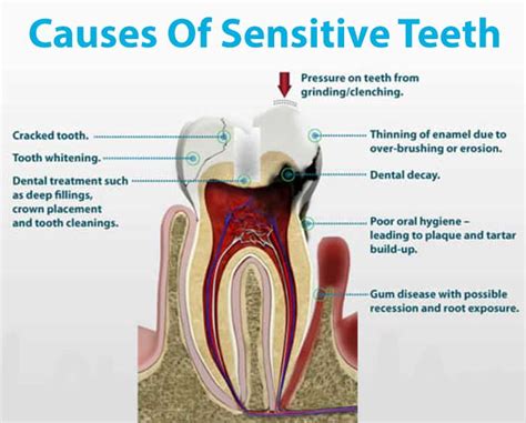 Why Are My Teeth Sensitive Mcomie Dentistry Chattanooga