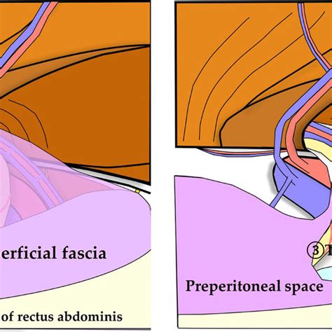 Pdf Surgical Technique Of Laparoscopic Hybrid Approach For Recurrent