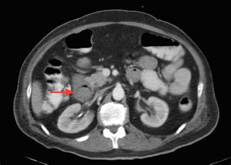 Abdominal Computed Tomography Showing Dilated Loops Of The Small Bowel